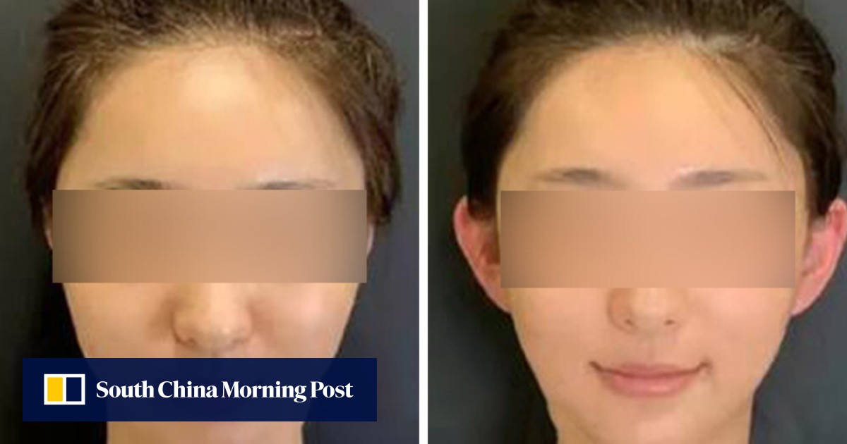 China’s ‘elf ear’ cosmetic surgery increasingly sought by young people ...