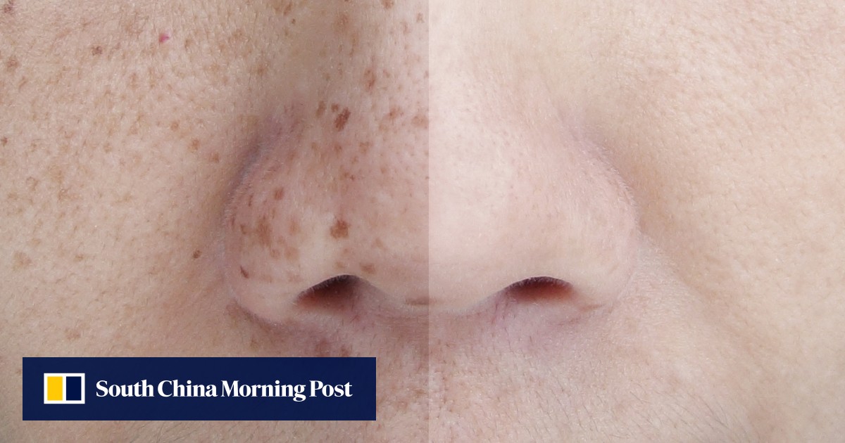 What causes hyperpigmentation – dark spots – on your face and how to ...