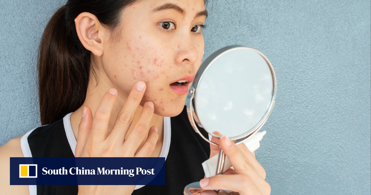 Do you have persistent acne? 5 sneaky reasons your skin may be ...