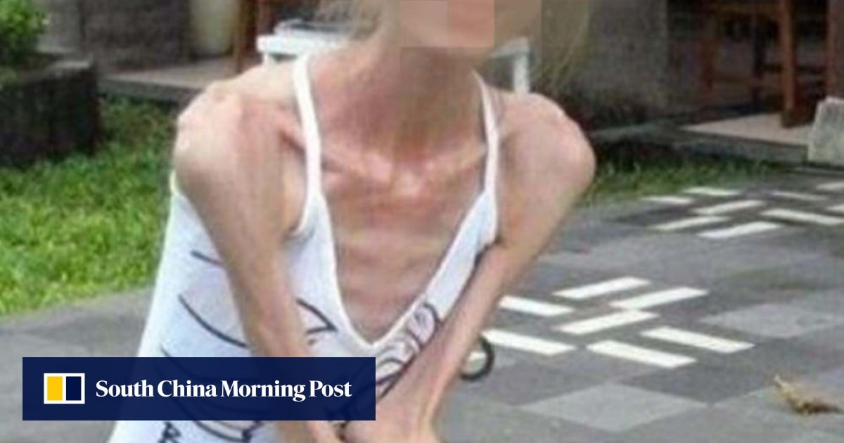 Chinas Beauty Slimness Obsession Highlighted After Womans Weight Drops To 25kg In A Year With