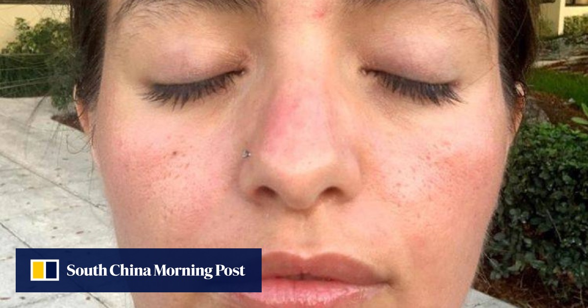 Microneedling ‘scraped off a layer of my face’: why people with darker ...