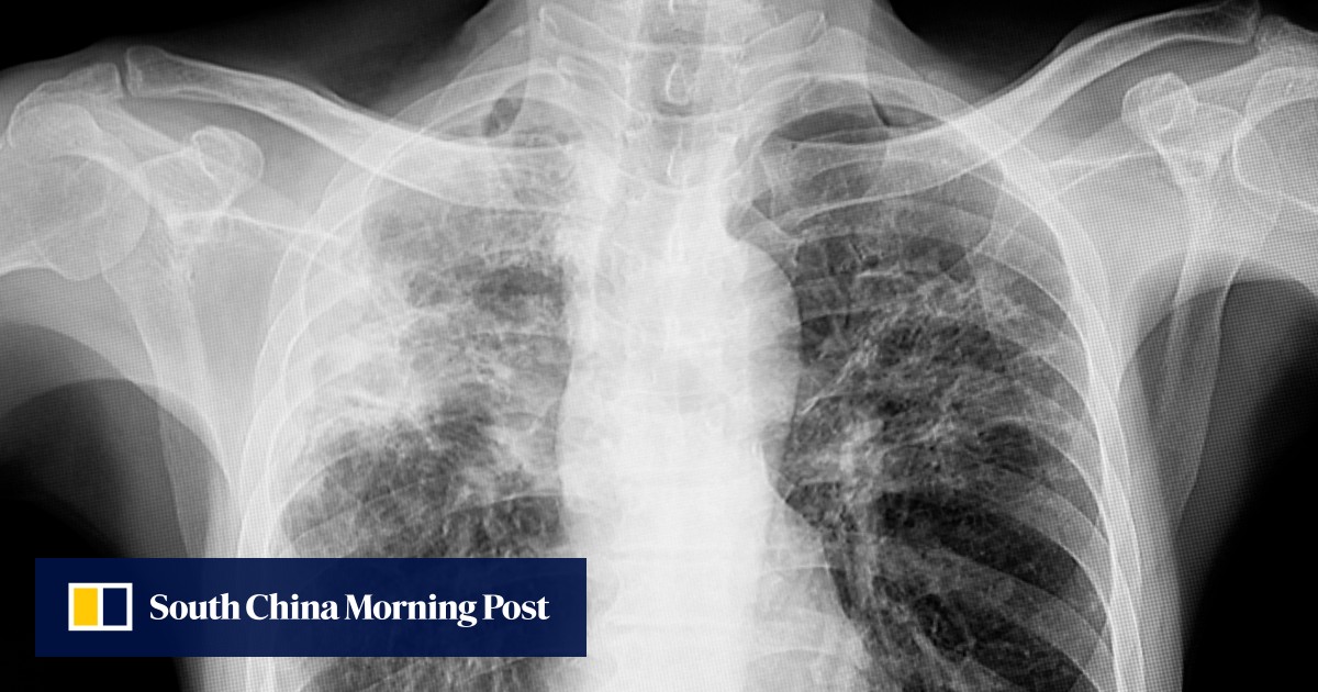 TB deaths during pandemic reversed years of decline, WHO says | South ...