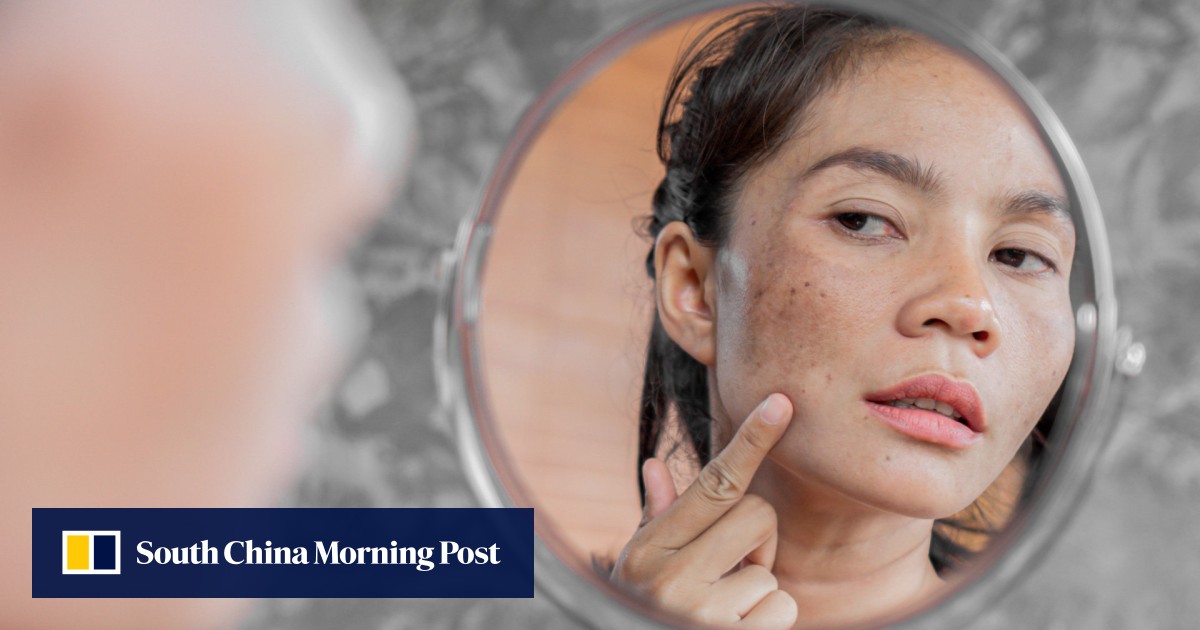 5 skin treatments you should avoid during the summer: from IPL sessions ...