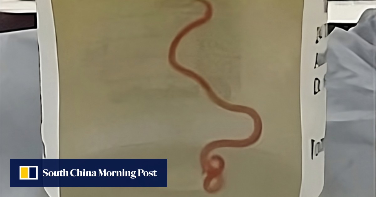 Doctors pull ‘alive and wriggling’ worm from brain of Australian woman ...