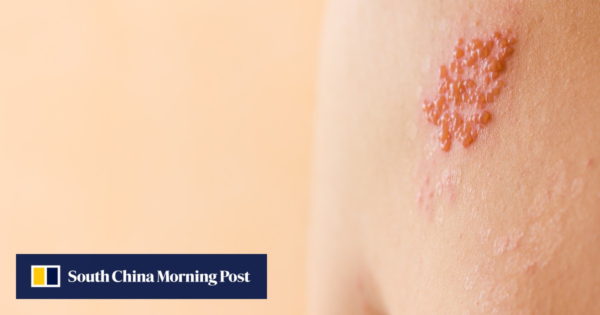 Hongkongers aged 50 or over should have access to free shingles ...