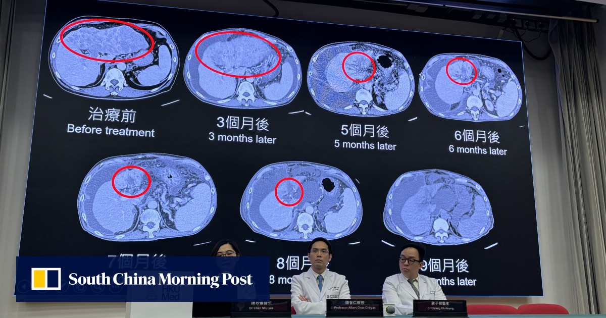 Treatment to reduce liver cancer tumours is world’s first, Hong Kong ...