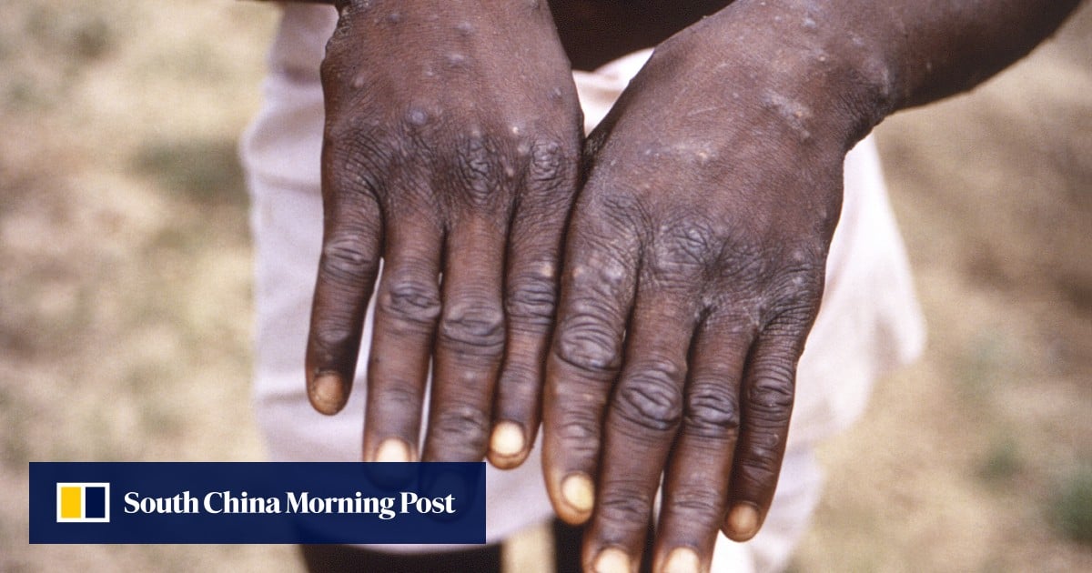 Stigma against gay men could worsen Congo’s biggest mpox outbreak ... Stigma against gay men could worsen Congo’s biggest mpox outbreak ...