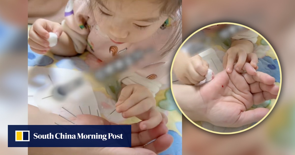 Video of China girl, 5, inserting acupuncture needles into hand under ...