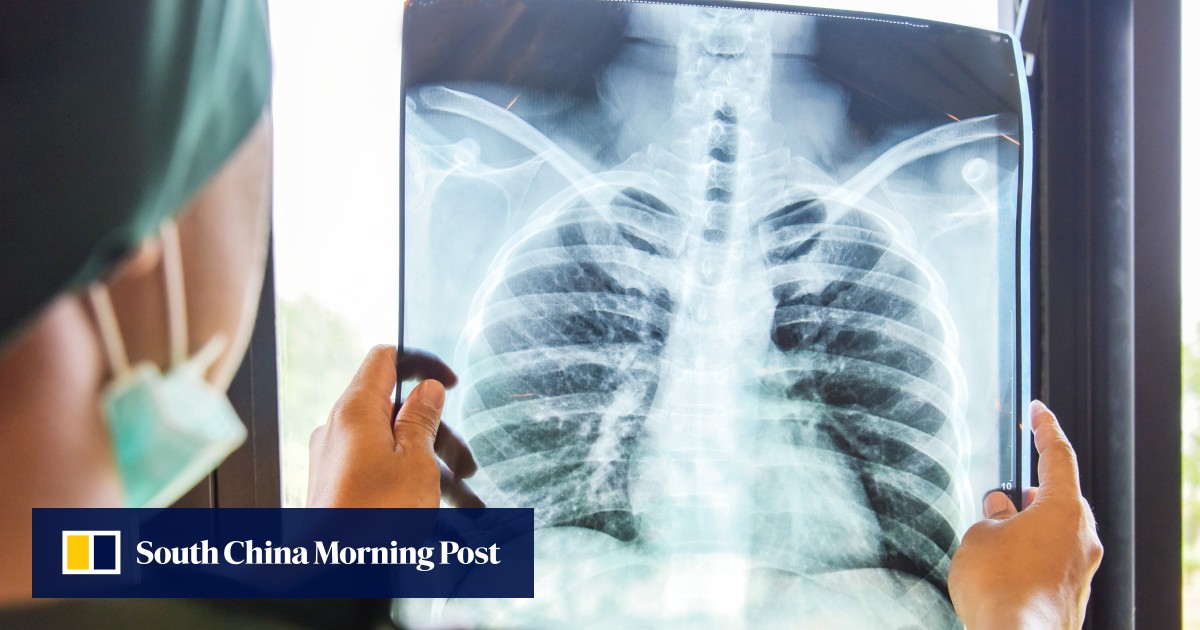 Chinese team tests lung treatment that may be first to reverse damage ...