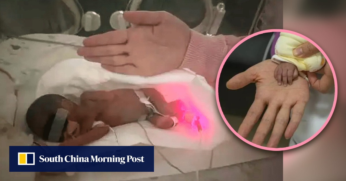 ‘Palm sister’ China baby born small as hand, light as 2 cans of soup ...