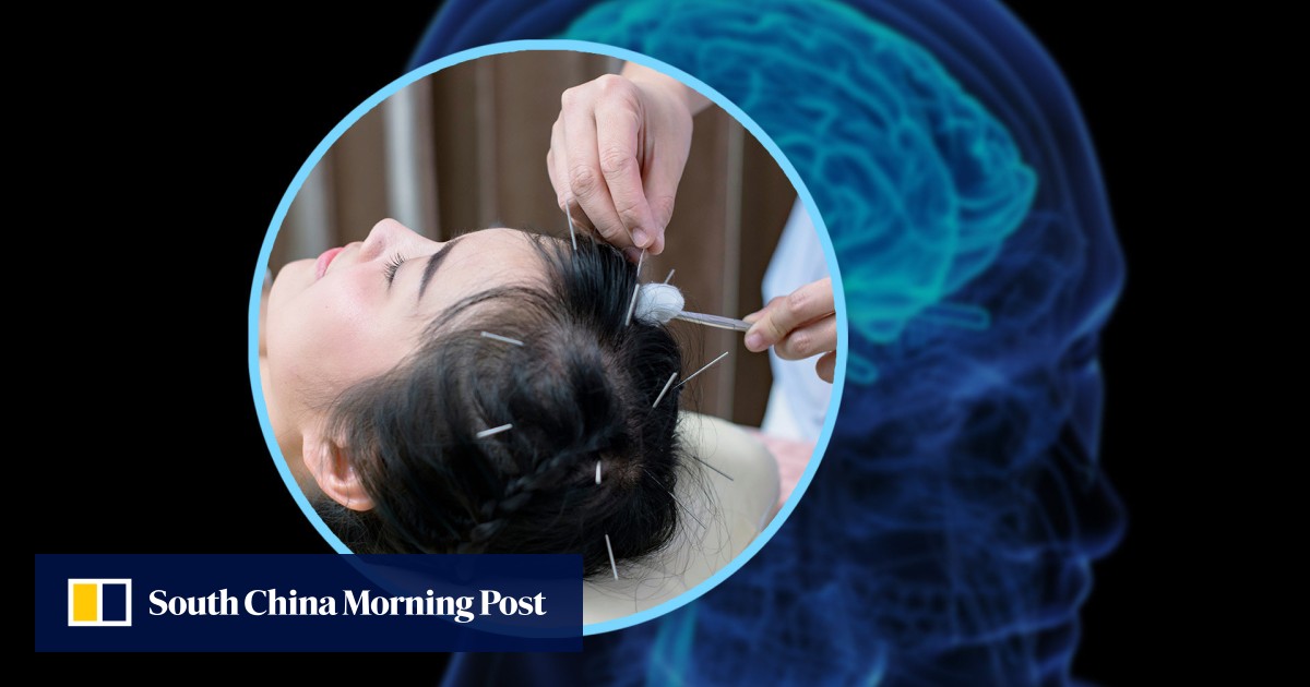 IQ boost: China clinic claims to make people smarter with acupuncture ...