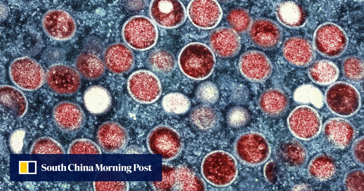 Hong Kong at risk of mpox outbreak as population has low immunity ...