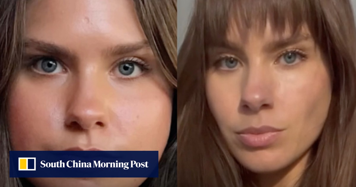 Swollen, puffy face? You might have ‘moon face’. Experts explain, share ...