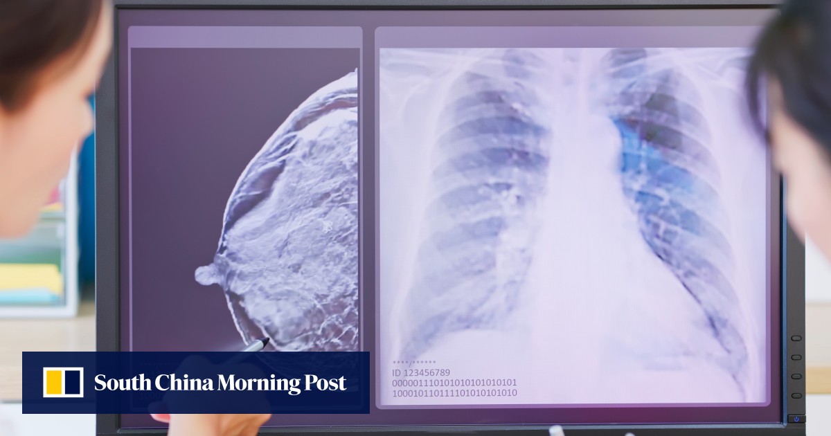University in Hong Kong develops AI breast cancer diagnostic tool that may plug labour gap ...