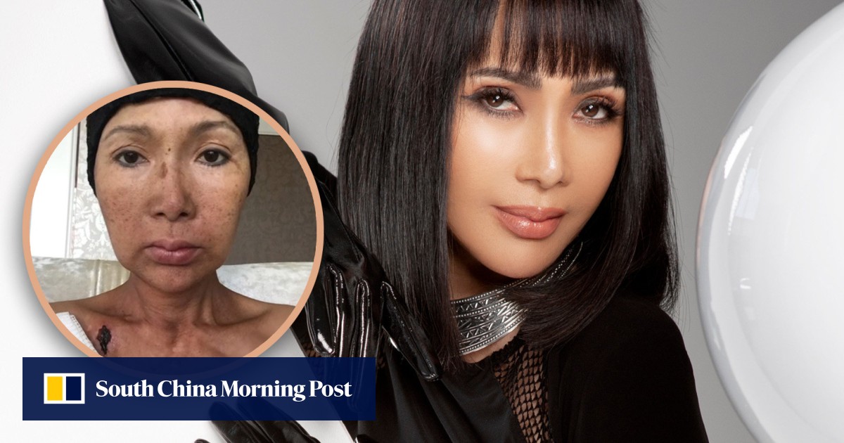 Chinese singer Zhang Mi battles cancer for third time, faces surgery to ...