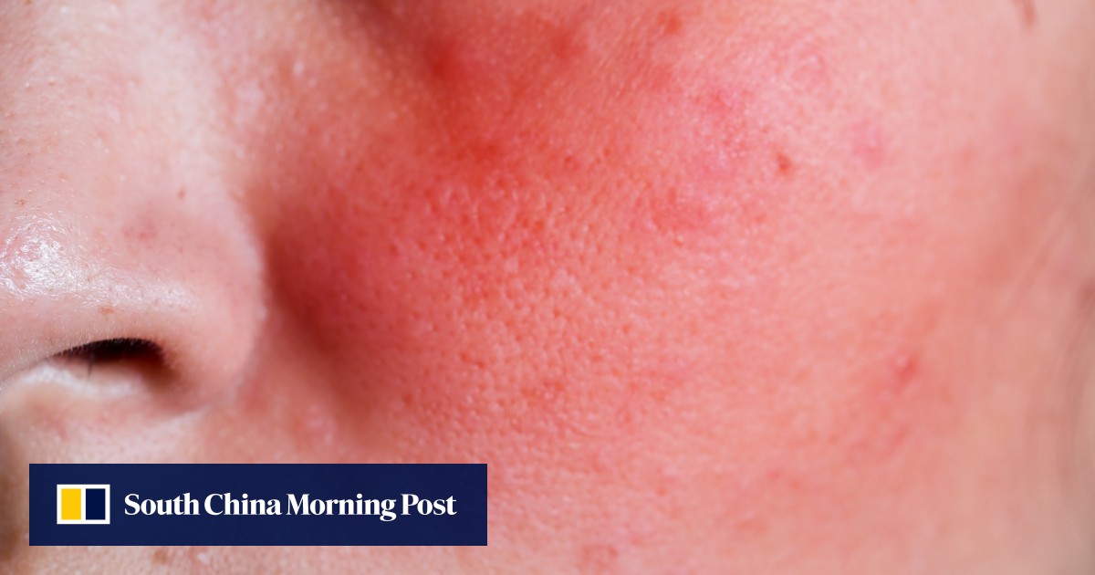 Japan faces worst ‘slapped-cheek syndrome’ outbreak in 25 years ...