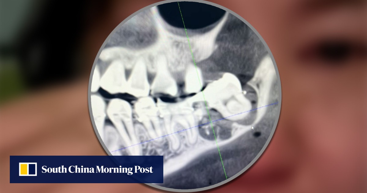 Chinese woman dies in hospital plunge after tooth extraction blunder ...