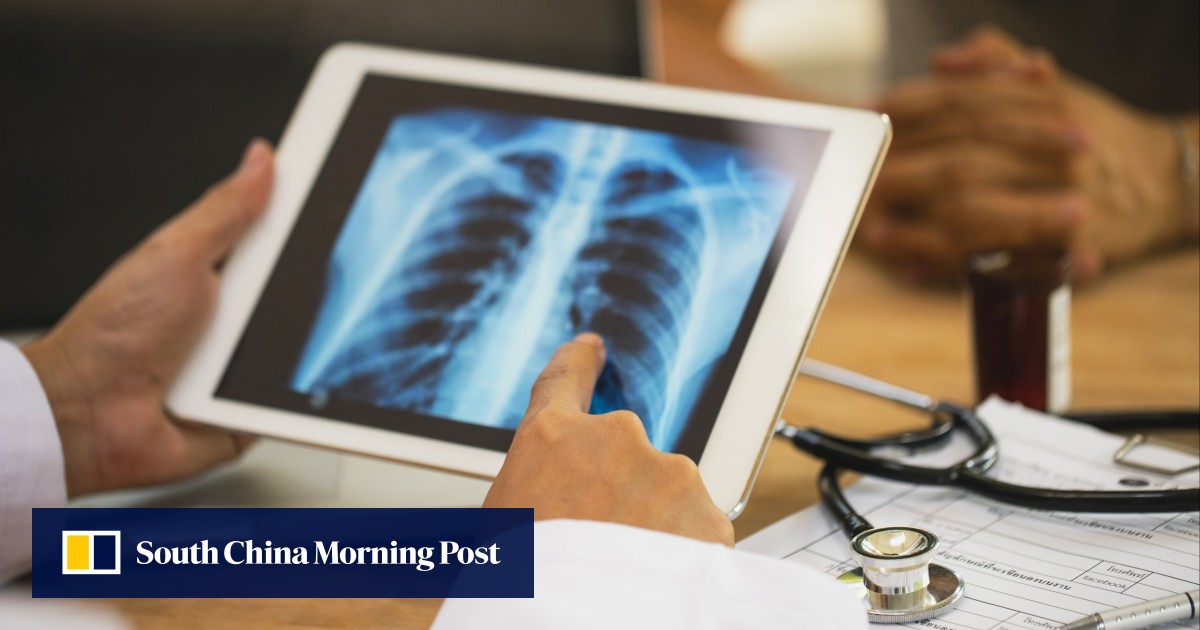 Targeted therapy could turn advanced lung cancer into chronic illness ...