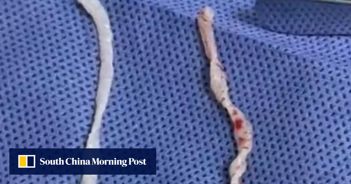 Chinese doctors remove pair of 10cm live worms from woman’s arm after ...