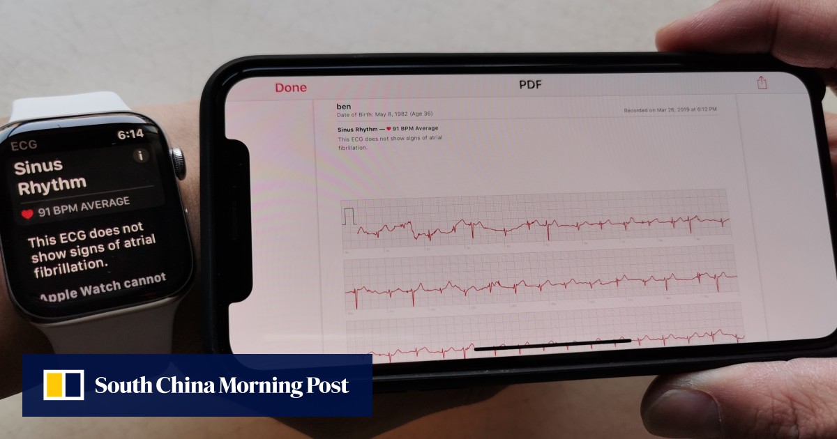 Apple Watch irregular heartbeat detection features debut in 19 markets ...