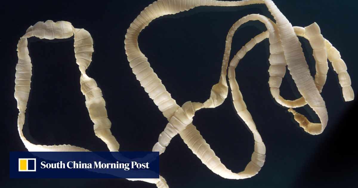 New York surgeons find tapeworm in Rachel Palma’s brain during search ...