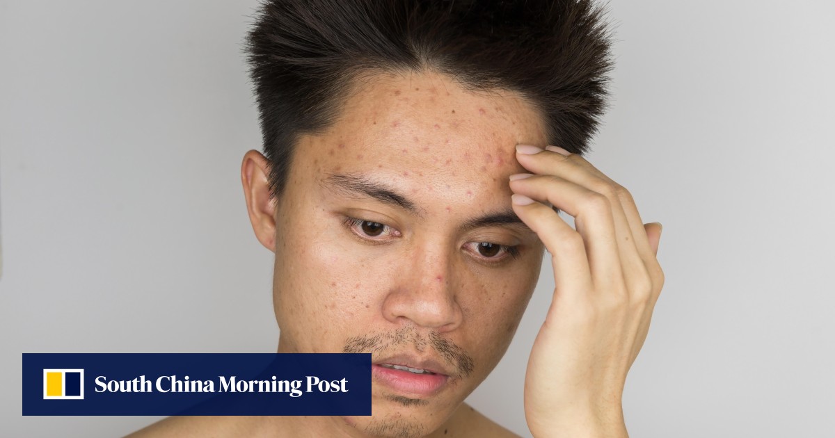 Adult Acne Explained What Causes It How To Treat It And Why Less Is