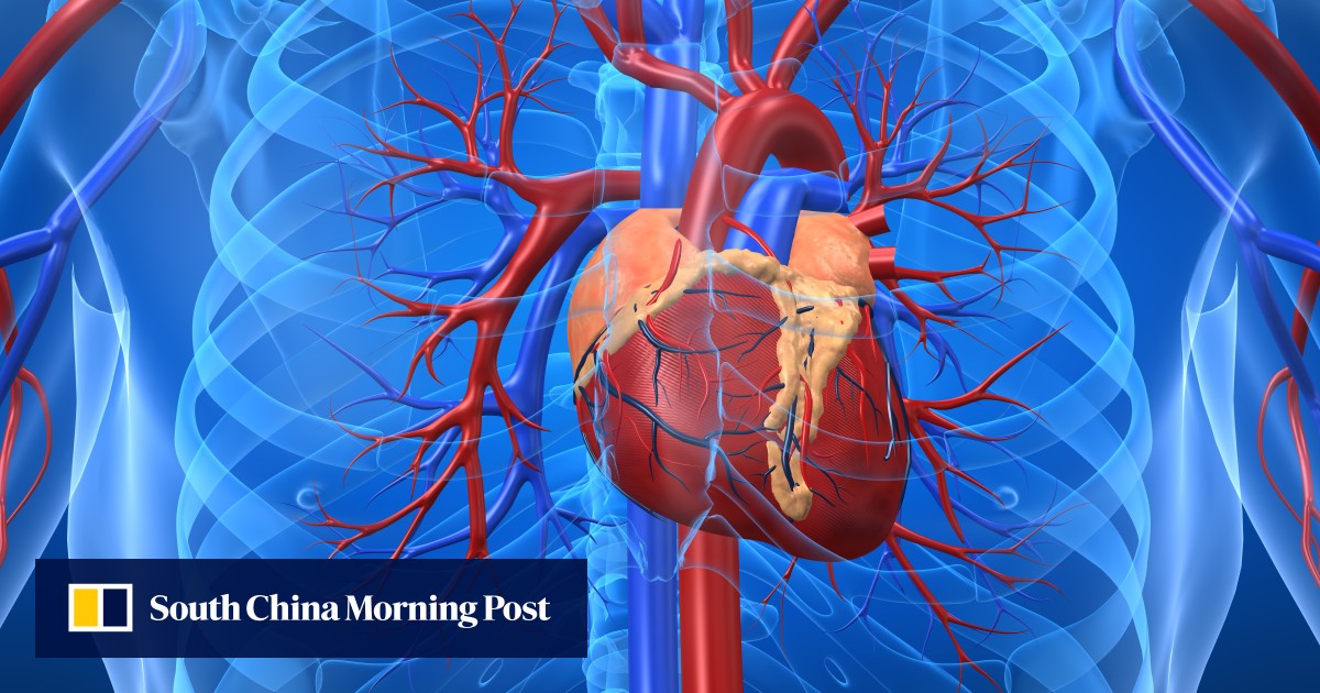 Chinese medical device maker’s US$2 a day heart attack risk warning ...