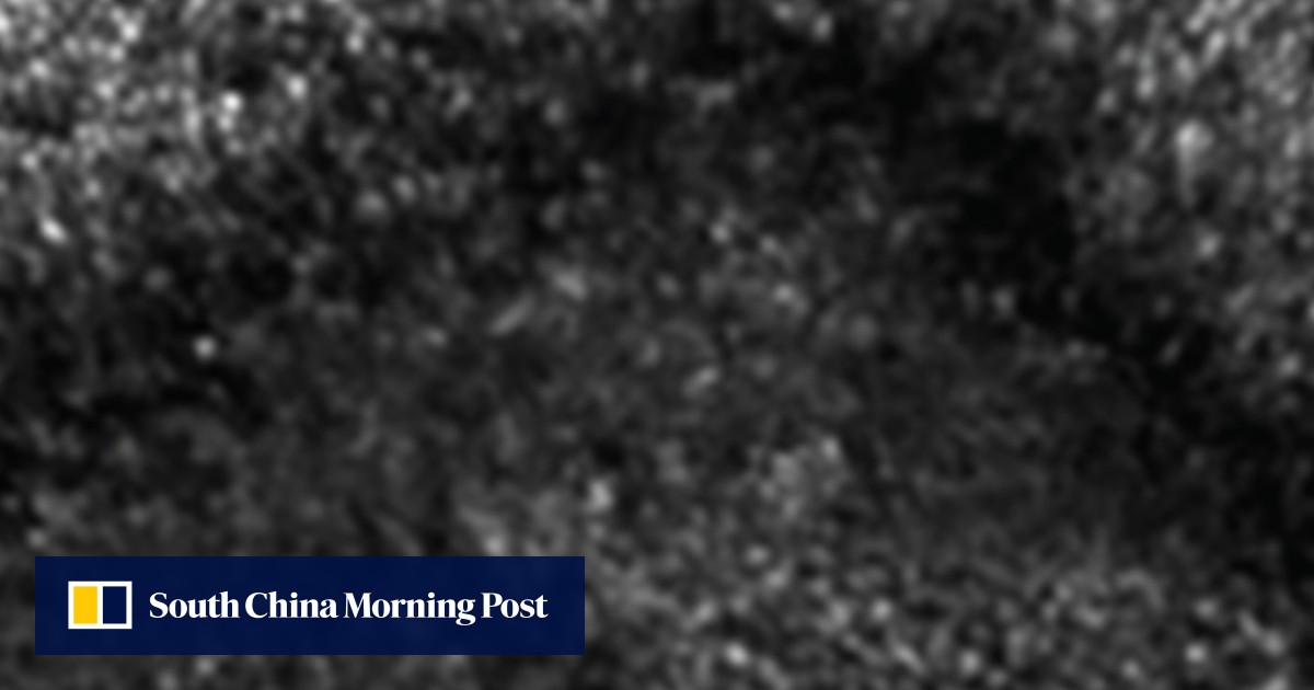 Solar eclipse was scorched on woman’s retina after she stared at sun ...