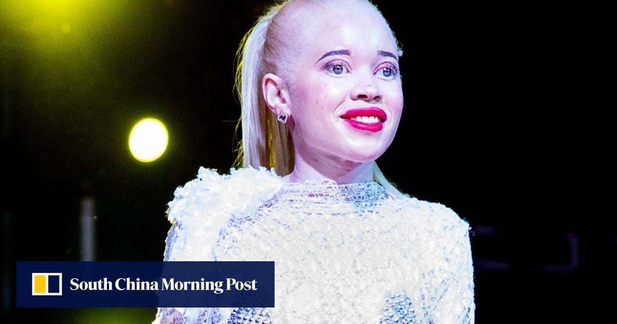 Zimbabwe holds ‘Miss Albino’ beauty pageant to fight stigma of the skin ...