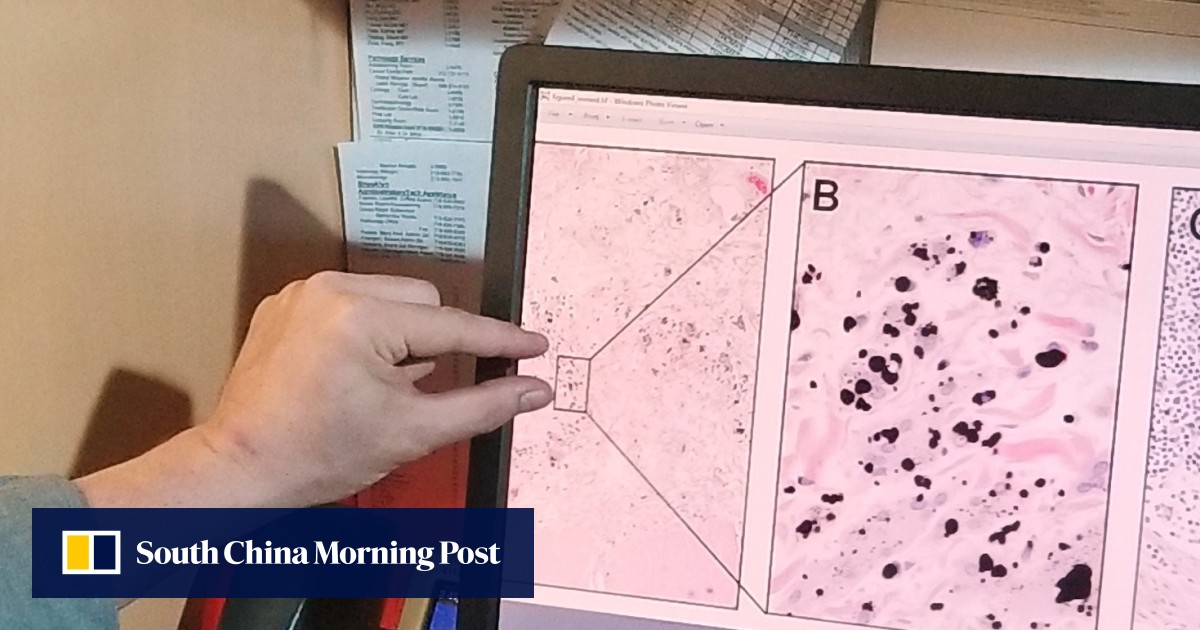 The interstitium is a newly discovered part of the human anatomy and it ...