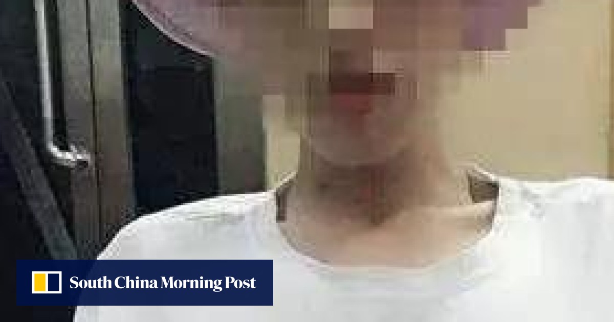 Anorexic Chinese woman, 21, wakes from 40-day coma after extreme ...