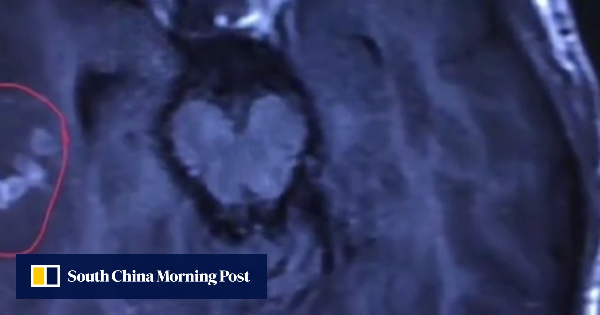Chinese doctors pull 10cm live worm from grilled food lover’s brain ...