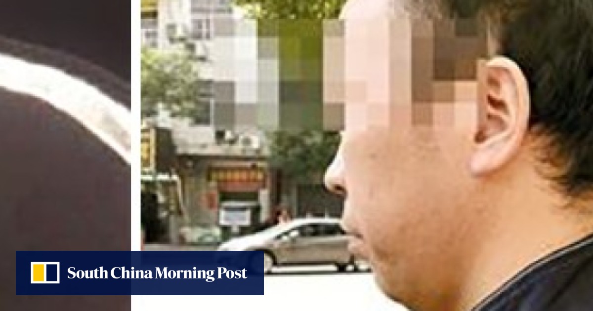 This Chinese man had a headache, and doctors found a nail in his head ...