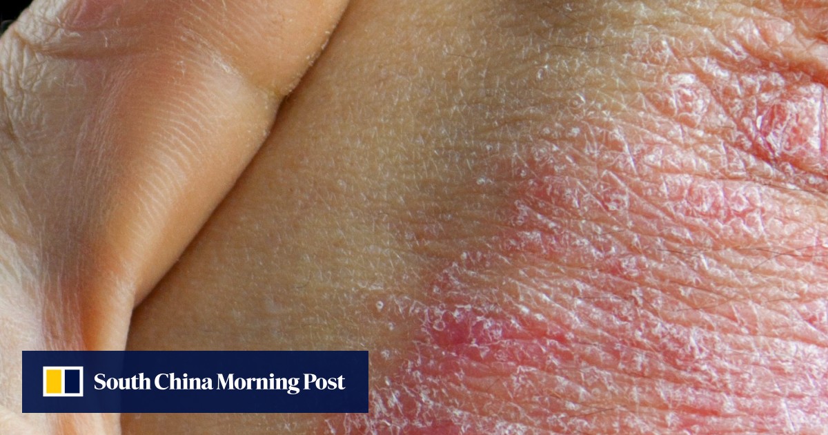 Psoriasis patients in Hong Kong seek quicker access to better treatment ...