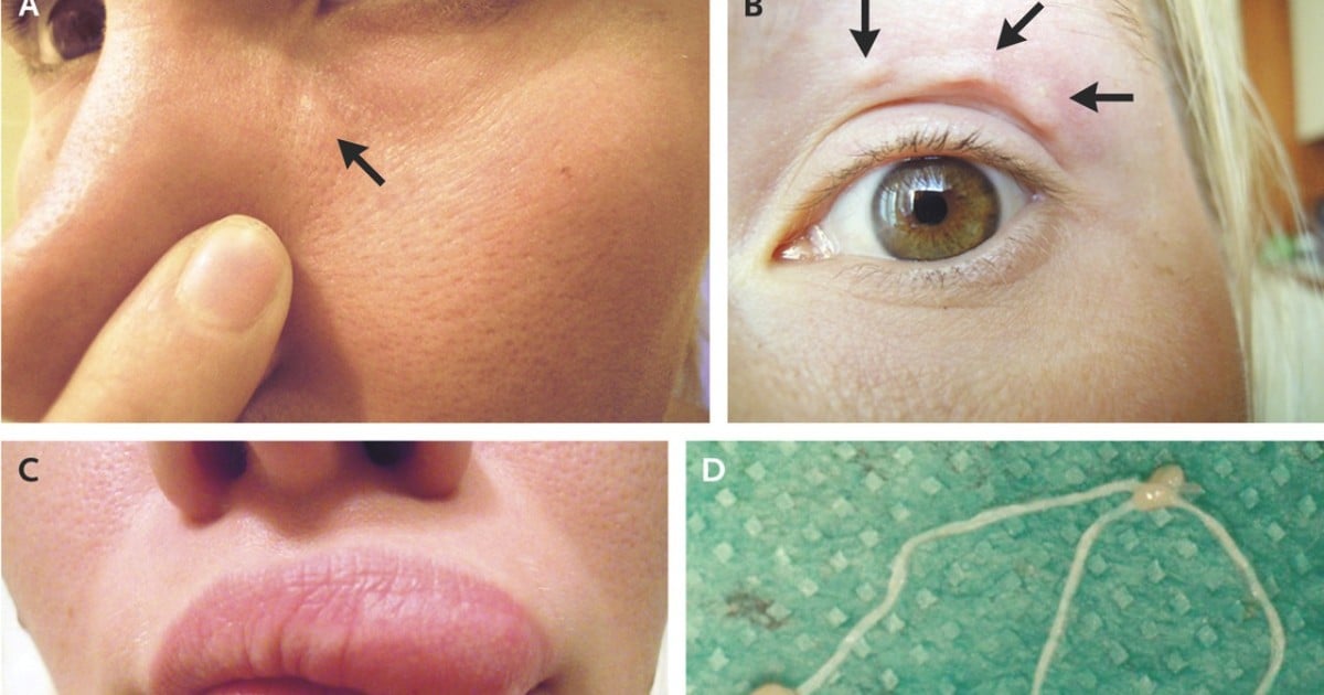 worms in face disease