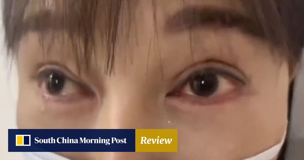 double eyelid surgery gone wrong