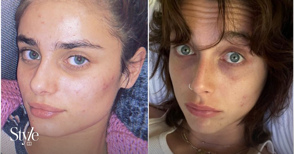 8 celebrities who struggle with acne: from Camila Cabello and Lucy Hale ...