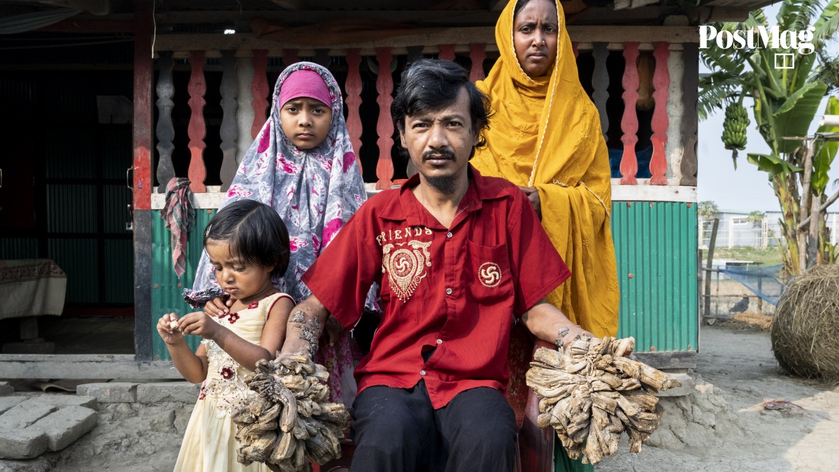 ‘The pain is unbearable’: viral ‘tree man’ with extremely rare disease ...