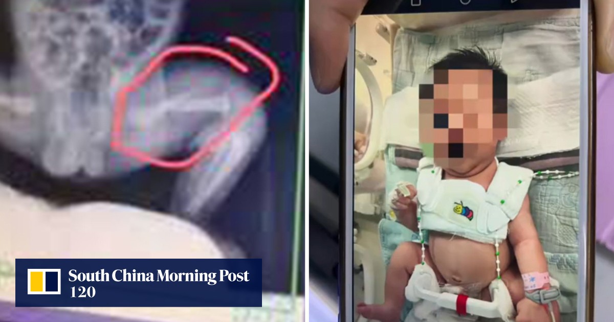 China child abuse: newborn suffers fractured thigh bone after nanny ...