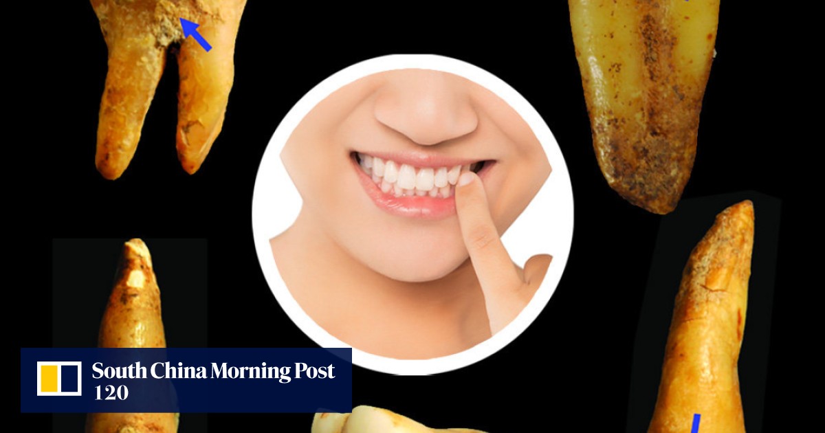 Do I have something in my teeth? Scientists find evidence of tooth ...