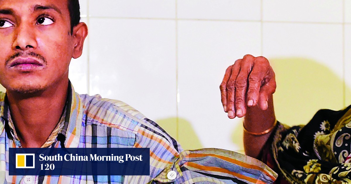 Bangladeshs ‘tree Man Prepares For Surgery To Have His Enormous ‘bark