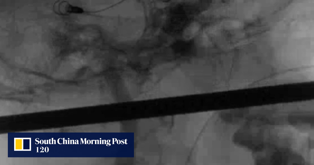 Miraculous survival of US boy Xavier Cunningham, 10, impaled through ...